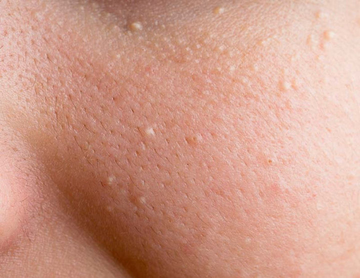 Advanced Laser Light Cork - Laser and Skincare Experts